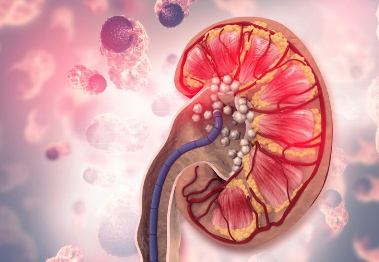 Flank Pain | Urologist | Mohammed Shahait, MD | Kidney Stone Specialist ...